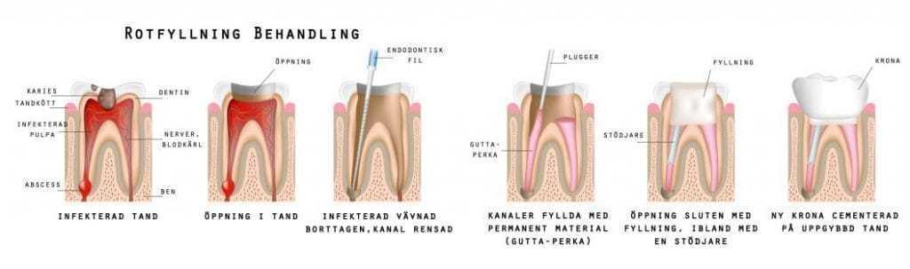 Rotfyllning - Endodonti | Tandläkare Stockholm | Svea Tandklinik