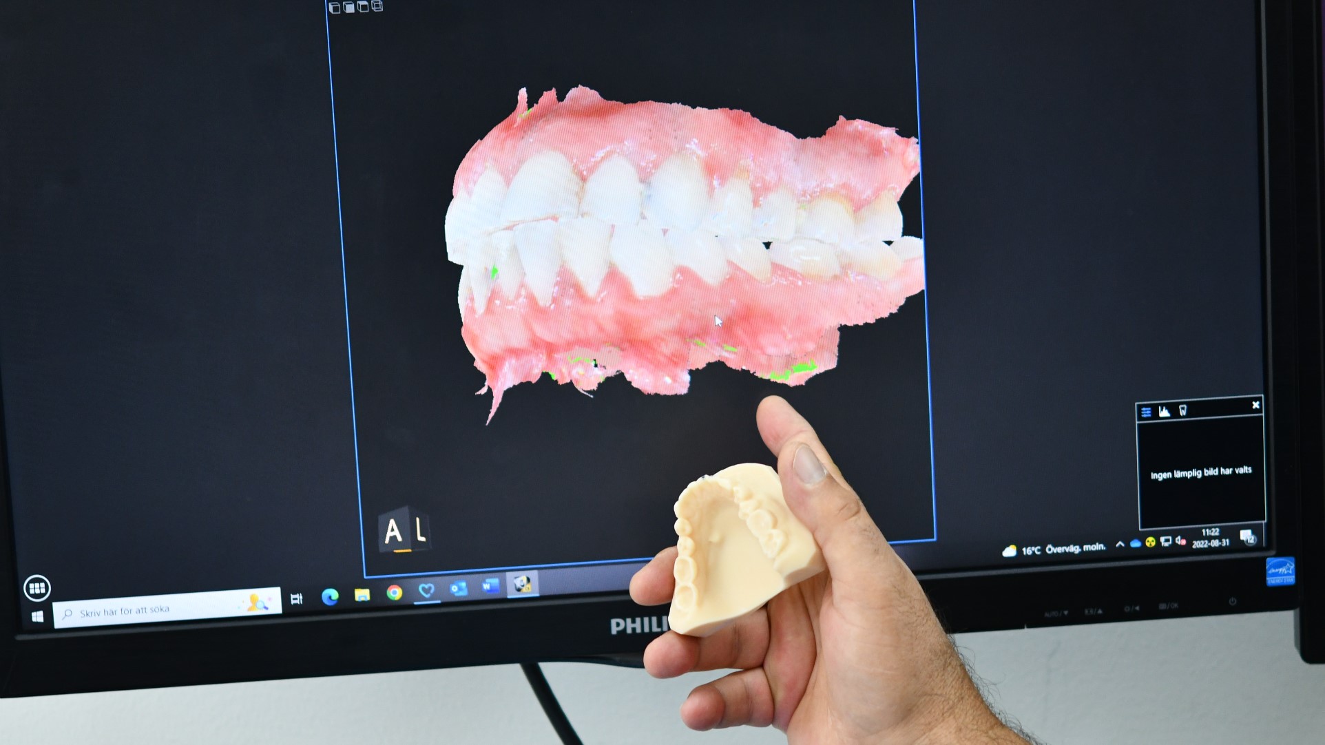 Tandlossning och vad är parodontit | Svea Tandklinik