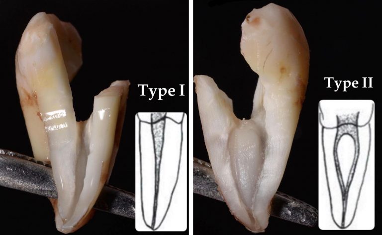 Rotfyllning - Endodonti | Tandläkare Stockholm | Svea Tandklinik